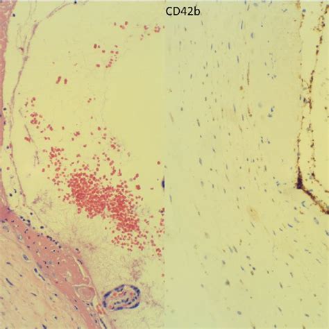Intervillous Thrombus With Hande Stain And The Immunohistochemical