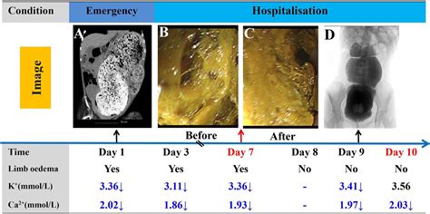 Frontiers Treatment Of Giant Fecalith Colonic Obstruction In A