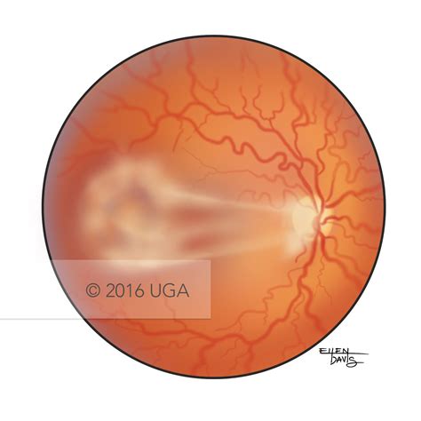 Precision Medical Media Clinical Presentation Of Ocular Toxocariasis