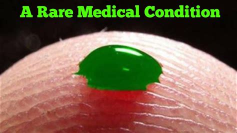 Why Does Blood Turn Green Sulfhemoglobinemia Rare Medical Case