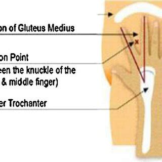 Three Intramuscular Injection Sites