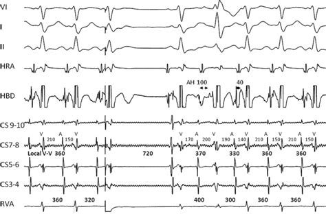 Intracardiac Electrogram During The Tachycardia The Tracings From The Download Scientific