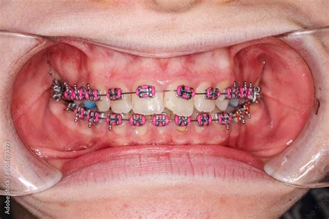 Dental Orthodontic Braces With Pink Colored Elastic Ligatures Front
