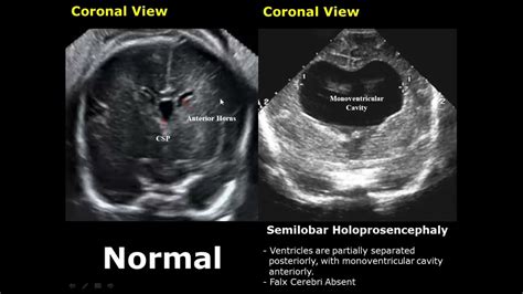 How To Read A Fetal Ultrasound At Pamela Harvey Blog