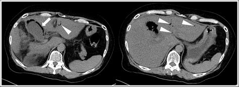 Secondary Sclerosing Cholangitis After Emphysematous Cholecy Acg
