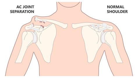 The Acromioclavicular Joint Musculoskeletal Key