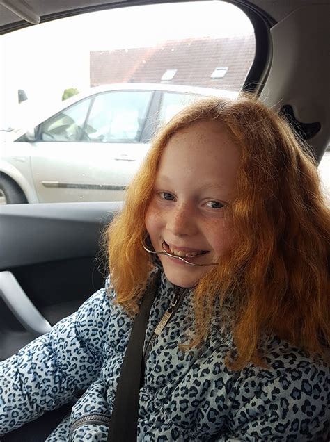 Untitled Braces Headgear Flickr Untitled Braces Headgear Flickr