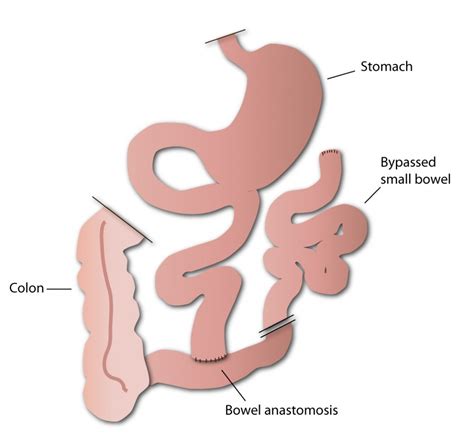 Jejunoileal Bypass Ileojejunal Bypass Intestinal Bypass