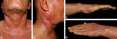 Nontuberculous Scrofuloderma With Sweet Syndrome Leading To Anti