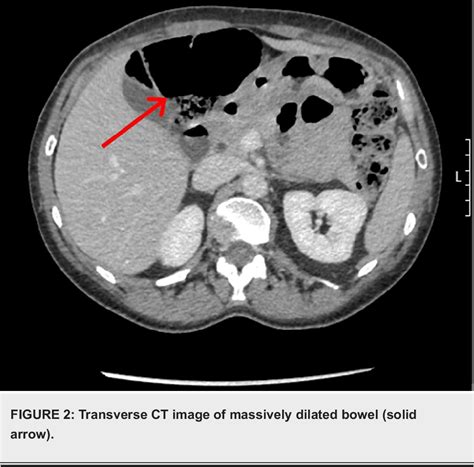 Figure 2 From Atypical Presentation Of Cecal Volvulus Semantic Scholar