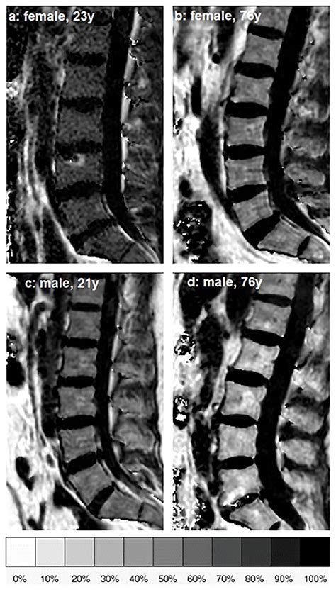 Frontiers Vertebral Bone Marrow Heterogeneity Using Texture Analysis