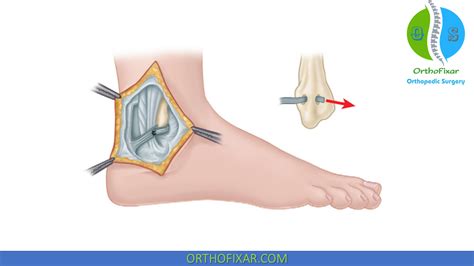 Peroneal Subluxation Orthofixar