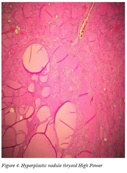 Parathyroid Adenoma With Concurrent Toxic Thyroid Adenoma A Rare