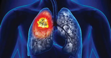 Survival Outcomes In Real World Settings After Alternative Pembrolizumab Dosing For Ncslc