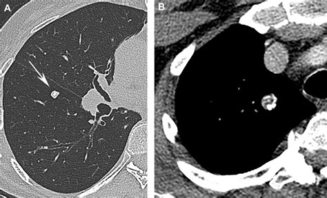 Incidental Lung Nodules On Cross Sectional Imaging Radiology Key