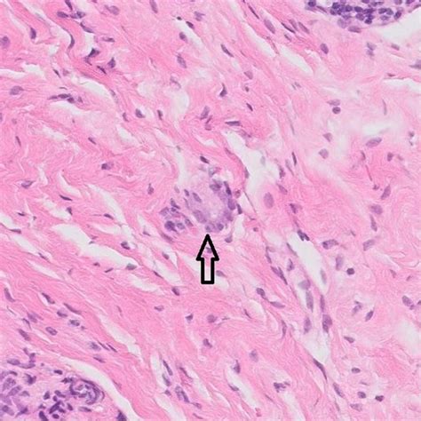 Immature Ganglion Cells Examples From Non Hscr Cases Without Evidence