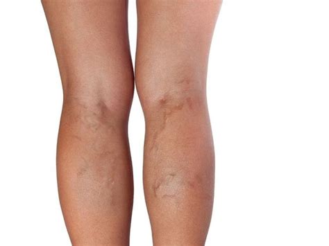 Detail Contoh Varises Ringan Koleksi Nomer 13