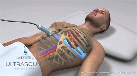 How To Obtain Subcostal Cardiac Ultrasound View Training And Techniques Icu Youtube