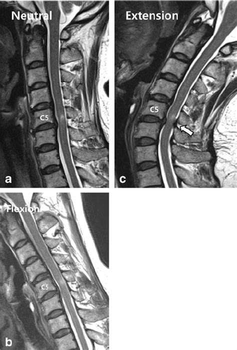 Cervical Compressive Myelopathy Was Verified Using Extension Magnetic Download Scientific