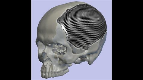Cranial Implant Modeling Using Only Freeware Youtube