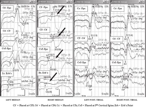 Somatosensory Evoked Potentials Ssep Data Showing The Loss Of Median Download Scientific