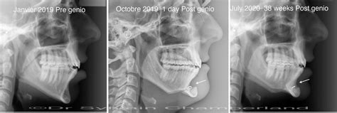 Isolated Functional Genioplasty Dr Sylvain Chamberland Orthodontist