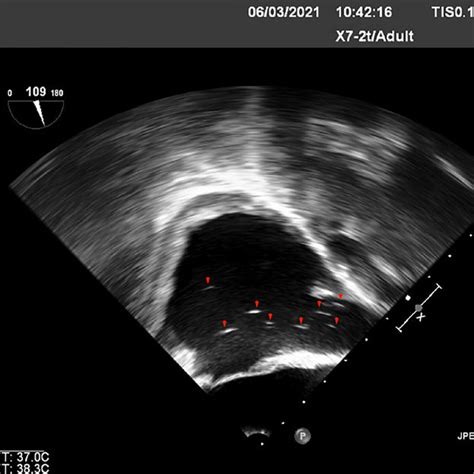 Injury To The Right Prostatic Venous Plexus During Singleport Injury To The Right Prostatic Venous Plexus During Singleport