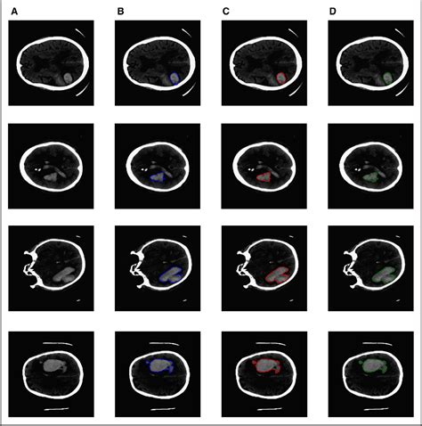 Figure 2 From Fully Automated Segmentation Algorithm For Hematoma