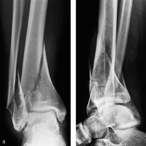 Cpt Code For Closed Reduction Of Distal Tibia Fibula Fracture At Josephine Hinkle Blog