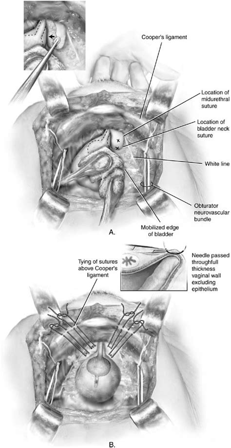 Burch Colposuspension