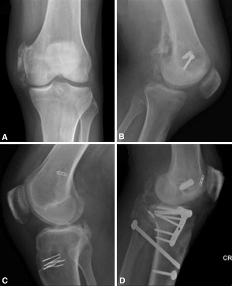 Risk Factors For The Development Of Heterotopic Ossification After Knee