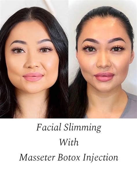 Masseter Botox Redefining Your Jawline