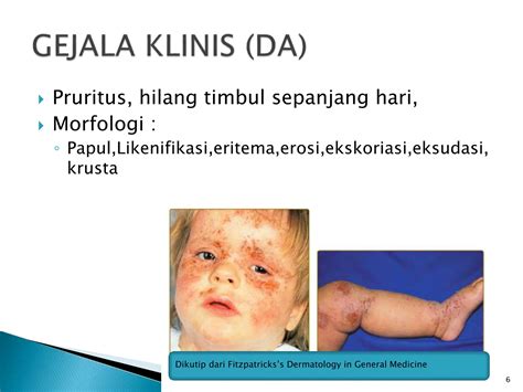 Sakit Kulit Ini Membunuhku Dermatitisppt