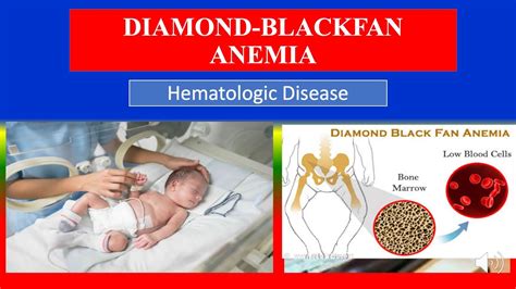 Diamond Blackfan Anemia Definition Types Causes Pathophysiology