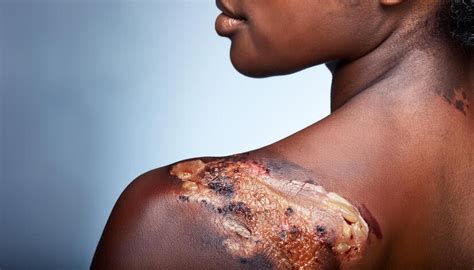 Stem Cell Therapy For Healing Severe Burns Premium Ai Generated Image