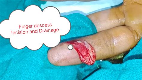 Incision And Drainage Of Finger Abscess Felon Real Case