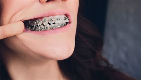 Tipos De Elásticos De Ortodoncia Puertas De Castilla