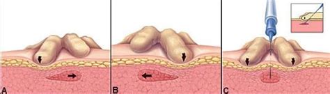 Trigger Point Injections Side Effects Complications Procedure