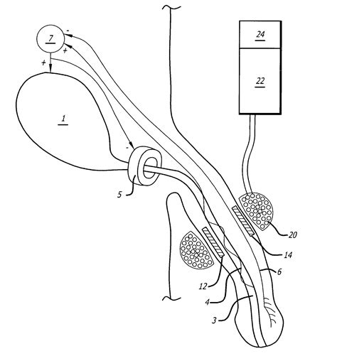 Bladder Capacity Patented Technology Retrieval Search Results Eureka