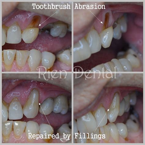 Toothbrush Abrasion