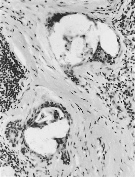 Pathology Outlines Microcalcifications
