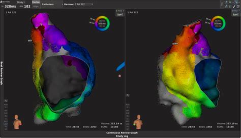 3d Electroanatomical Map Of The Right Atrium Of A Patient With Ph
