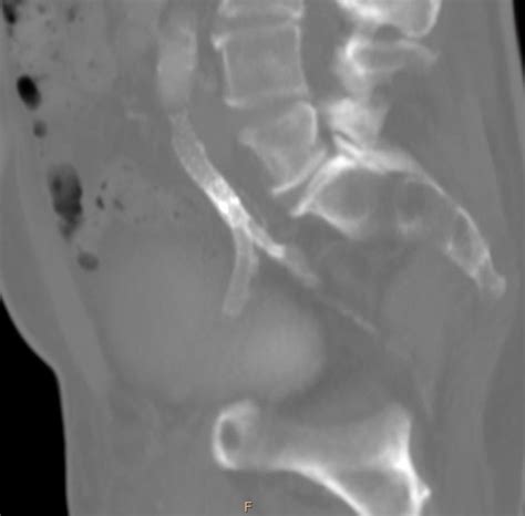 Covered Endovascular Repair Of Iliac Bifurcation Cerib Procedure V A S C N O W