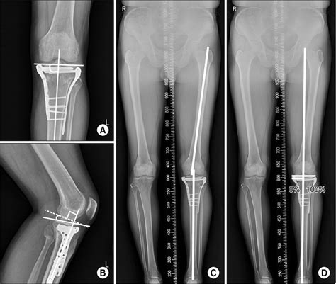 Proximal Tibia Plate