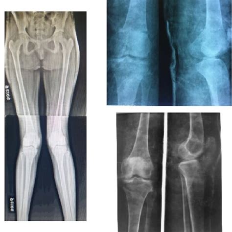 Serial Radiographs In A 16 Year Old Pre Operatively Immediate Post Op Download Scientific