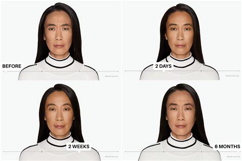 Daxxify The Longer Lasting Botox Alternative For Fewer Touch Ups