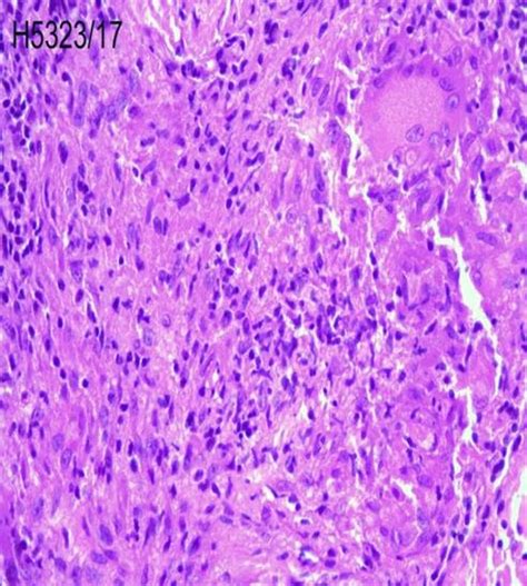 Single Erythematous Brown Colored Plaque With Atrophy In Centre And