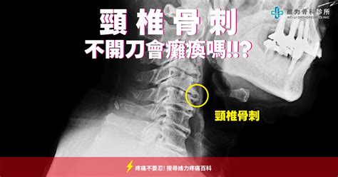 維力骨科診所 頸椎骨刺，不開刀會癱瘓嗎😨 有骨刺免驚！🙏讓專業醫師告訴你怎麼與骨刺共生