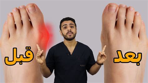 ألم صباع القدم الكبيراهم التمارين لعلاج الم وتورم وخشونة والتهاب صباع