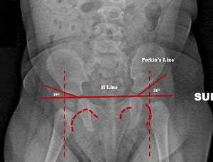 Pediatric Hip Disorders Radiologic Clinics